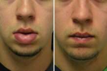 Lip Reduction Surgery : Is It Worth It? My 2-Week Recovery!